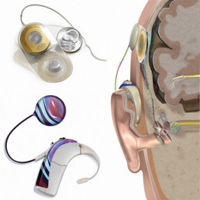 Acoustic Co-ordinated RESET Neuromodulation To Treat Tinnitus – My Cure ...